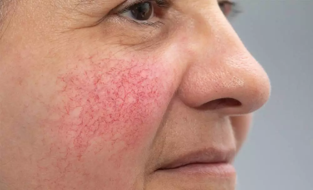 Thread Vein Removal in Norwich | The Doctors Laser Clinic