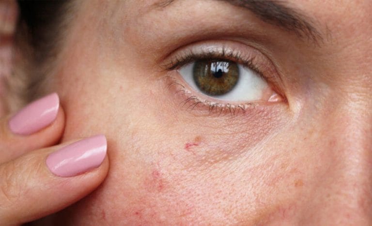 Thread Vein Removal Norwich | Laser & IPL Vein Treatments