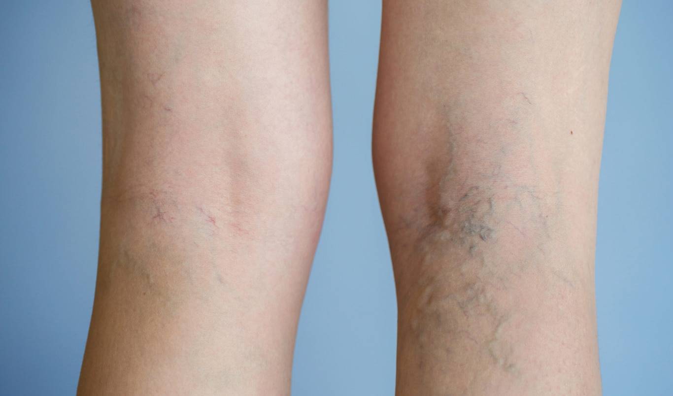 Thread Vein Removal Norwich | Laser & IPL Vein Treatments