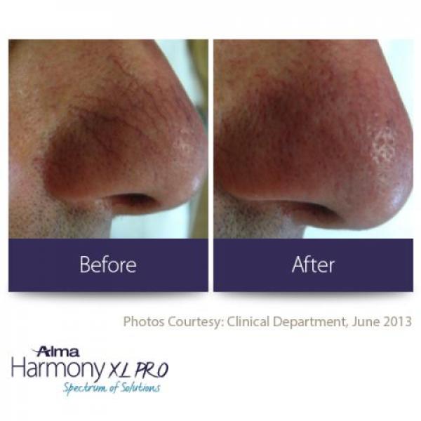 Thread Vein Removal: Before and After Insights