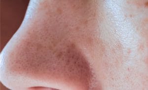 Enlarged Pore Treatments | Open Comedone Therapy