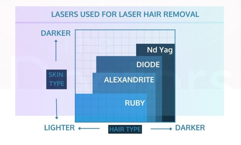 A Guide On The various Types Of Lasers For Hair Removal
